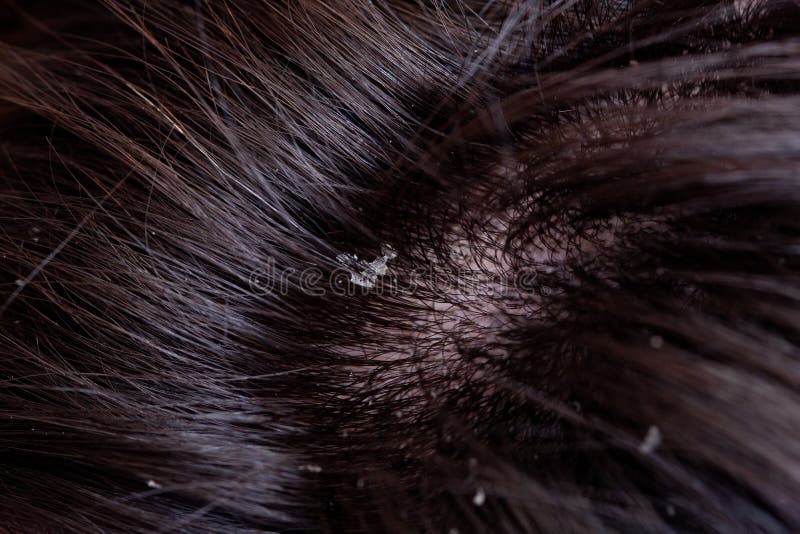 Schuppen Im Haar Flockige Kopfhaut Seborrhea Stockfoto - Bild von pilz ...