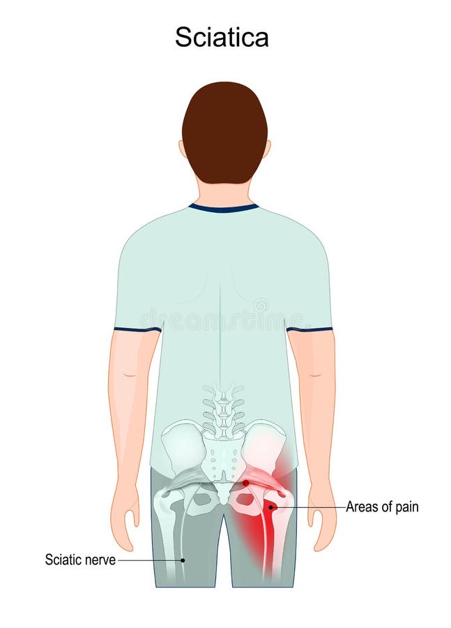 Sciatica. Areas of pain stock vector. Illustration of injury - 230532203