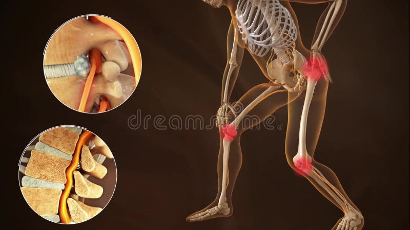Sciatica Caused by a Herniated Disc, Which Compresses the Spinal Nerves ...