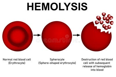 Scientific Diagram and Process of Hemolysis Stock Illustration ...