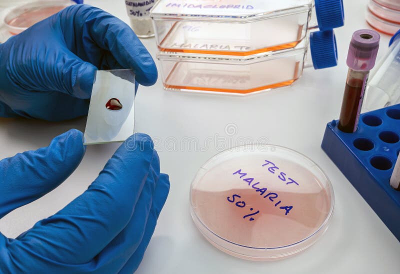 Scientist Examines Blood Sample from Sick Person with Malaria in ...