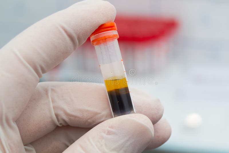 Scientist Holding in His Hand a Centrifuged Blood Sample with Hemolysis ...