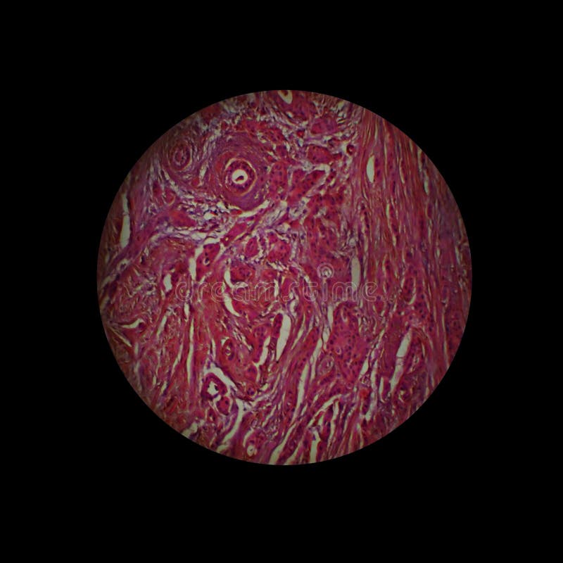 Scirrhus of mammary gland stock image. Image of micro - 17564745