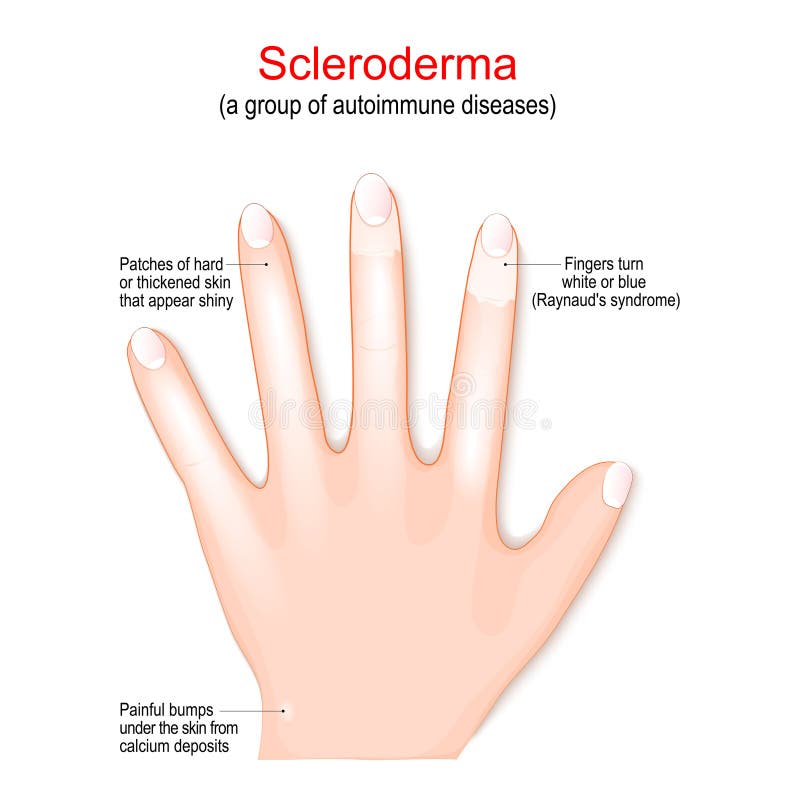 Scleroderma. Autoimmune Disease. Signs and Symptom Stock Vector ...