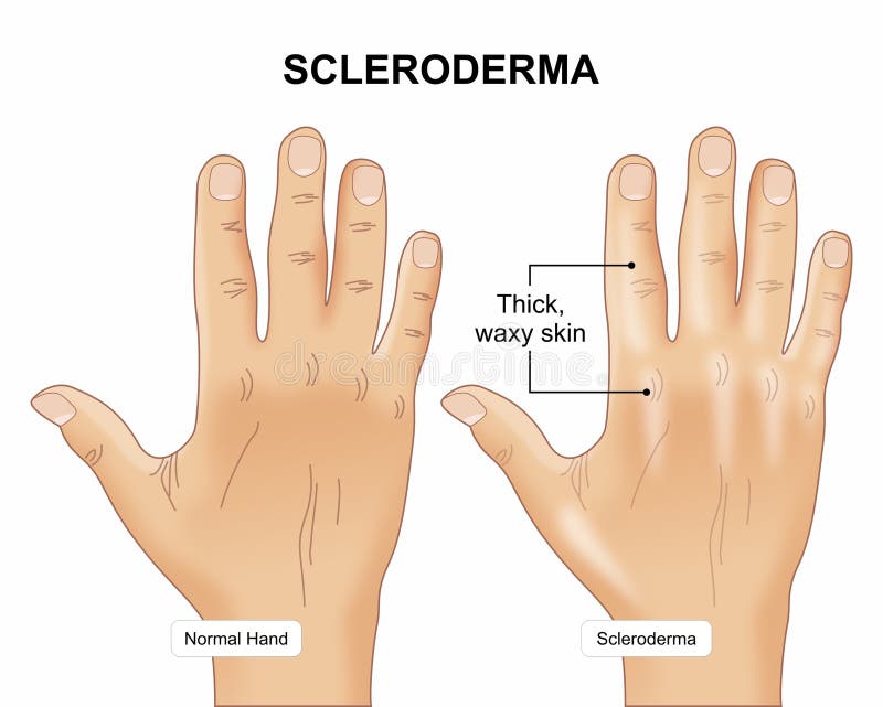 Scleroderma Illustration stock image. Illustration of finger - 391892989