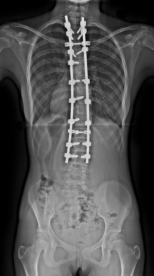 4,814 Scoliosis Stock Photos - Free & Royalty-Free Stock Photos from ...