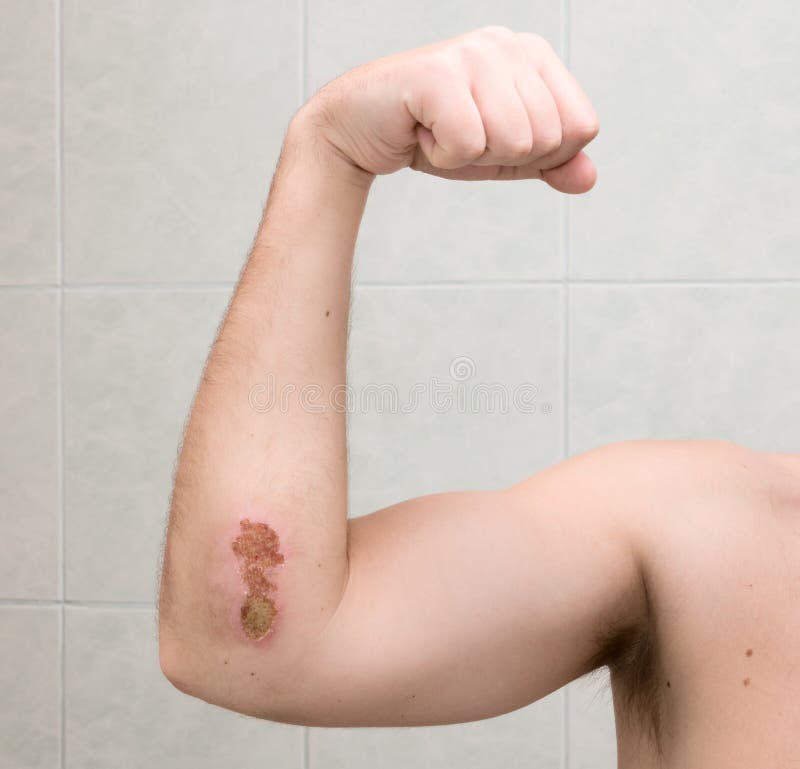 Scraped elbow #1 stock photo. Image of pain, scratch, skin - 6777262