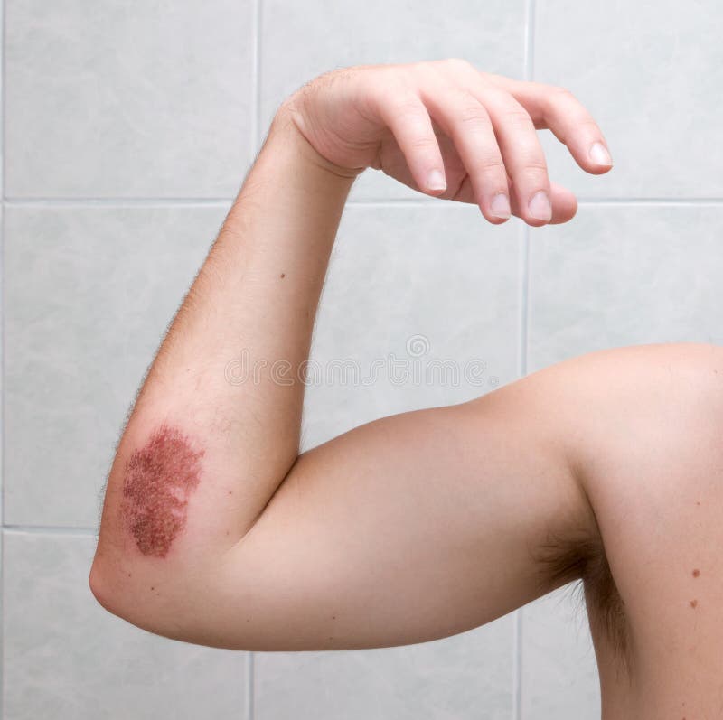 3,292 Wound Healing Photos - Free & Royalty-Free Stock Photos from ...