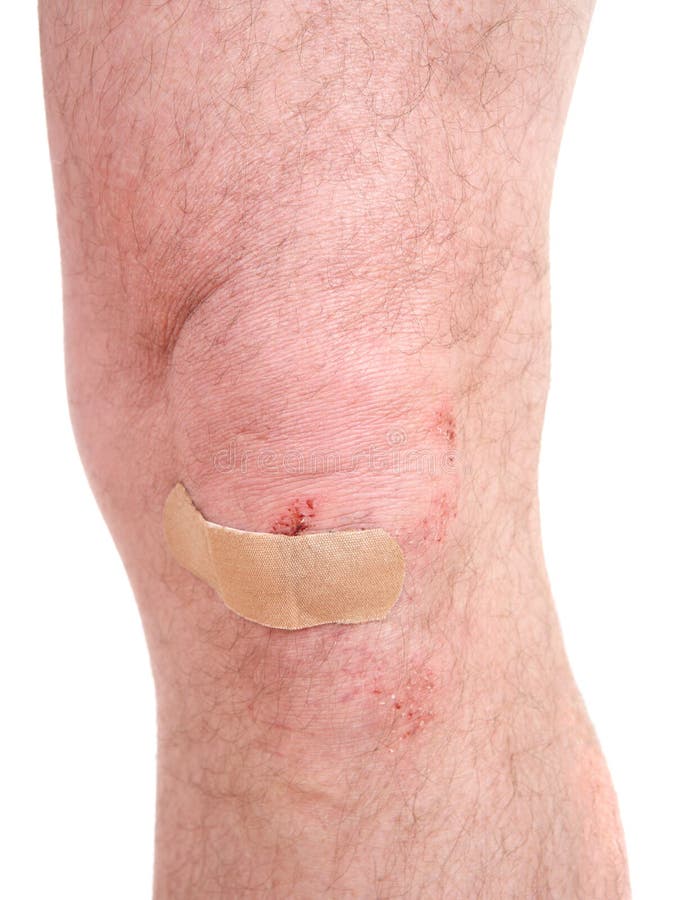 Scraped knee stock photo. Image of inflamed, heal, clot - 4334524