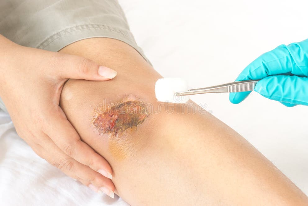 Scraped knee stock image. Image of skin, painful, bleed - 47450627