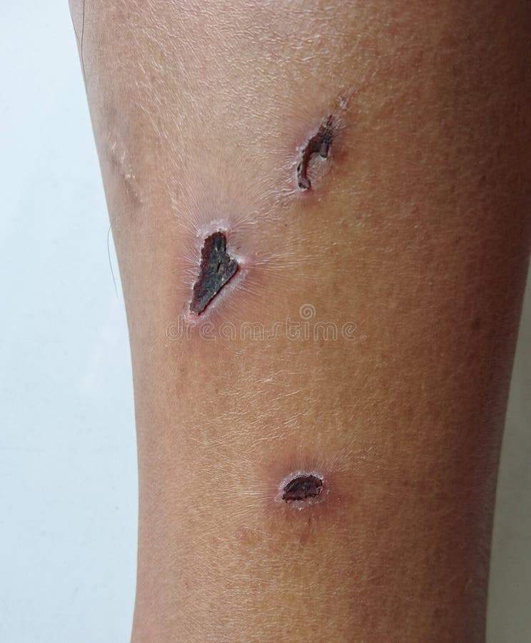 Scraped lesion at shin stock image. Image of scrape - 116852523