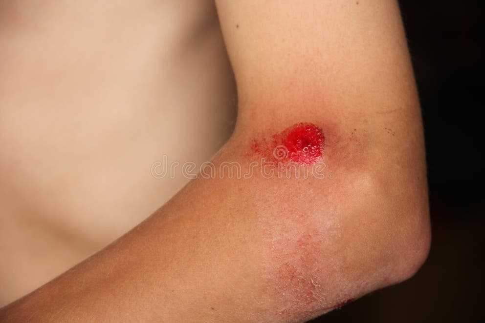 Scraped Up Bleeding Elbow stock photo. Image of accident - 9886570