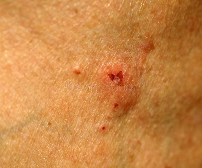 Skin Abrasion Stock Photos - Download 970 Royalty Free Photos