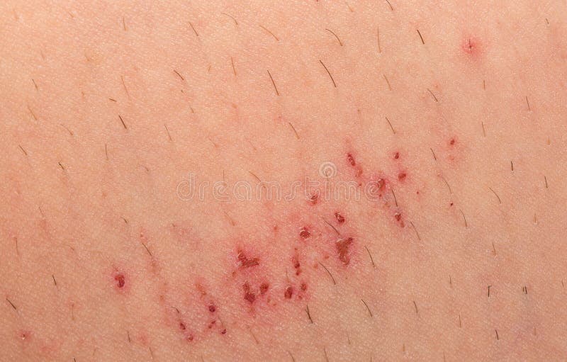 Scratch stock photo. Image of detailed, skin, scab, caucasian - 30443728
