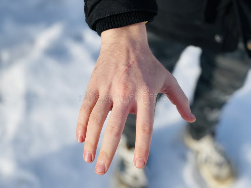 Scratch on a Hand, Close Up Stock Photo - Image of person, hand: 226320970