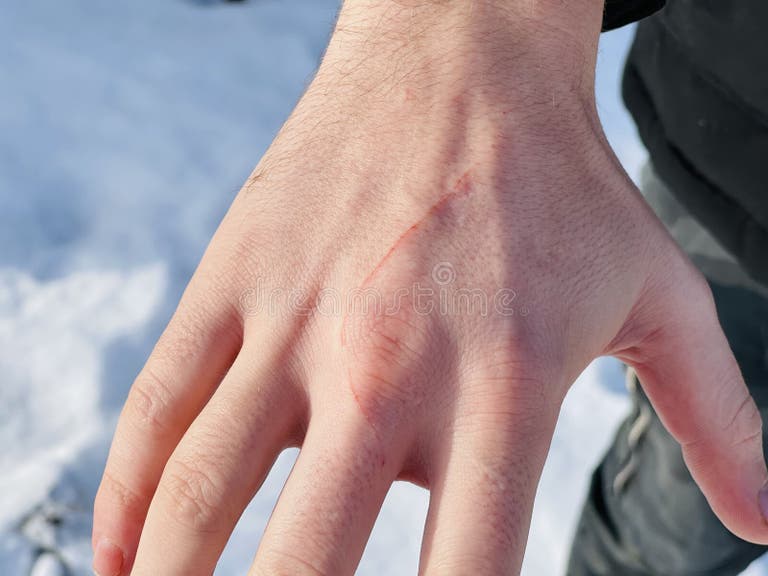 Scratch on a Hand, Close Up Stock Image - Image of injured, person ...