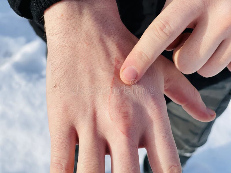 Scratch on a Hand, Close Up Stock Photo - Image of scratch, deep: 226321048