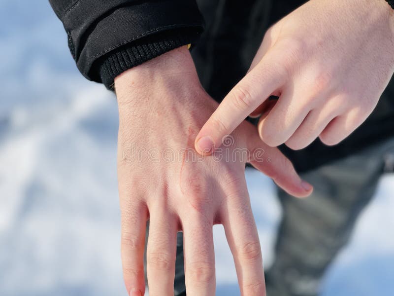Scratch on a Hand, Close Up Stock Image - Image of scratch, person ...