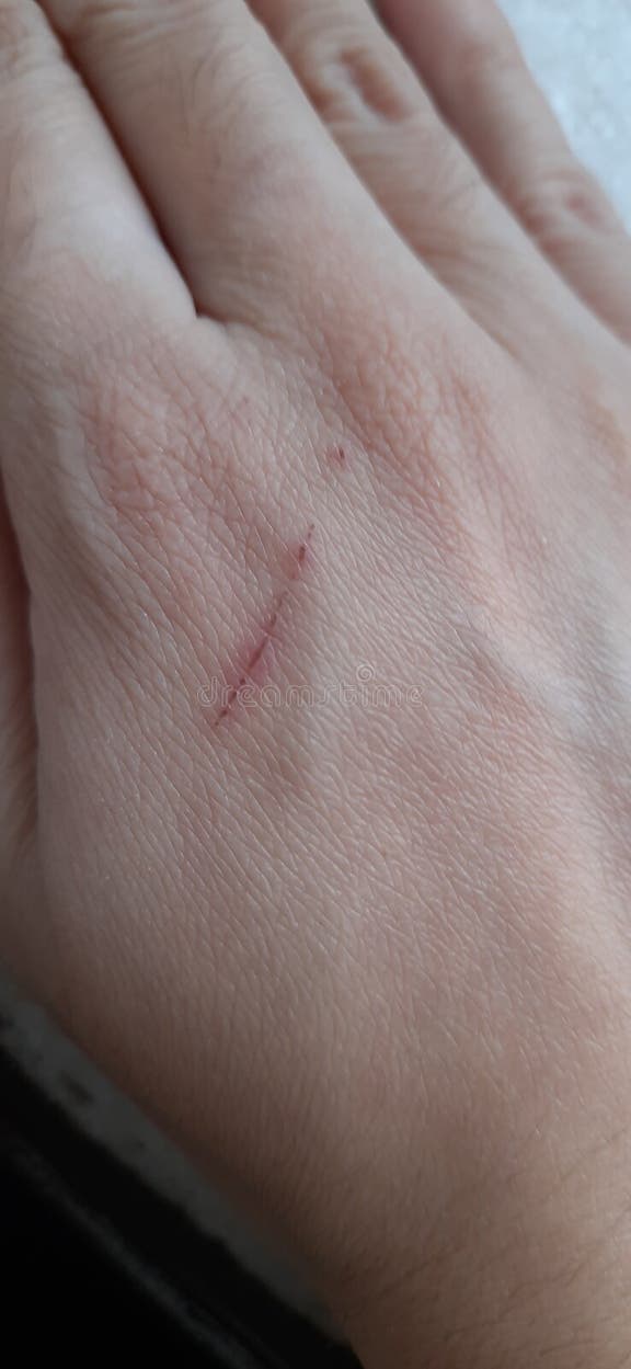 Scratch on Human Hand Healing Scar Stock Photo - Image of palm, scar ...
