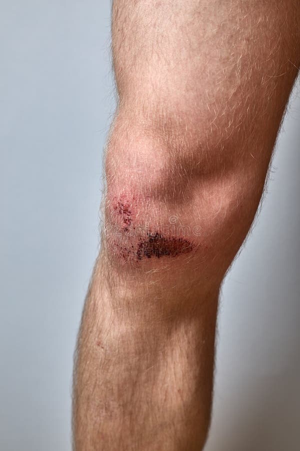 Scratch, Knee Wound on a Man& X27;s Knee Stock Image - Image of skin ...