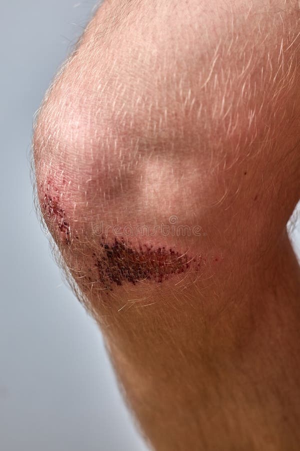 Scratch, Knee Wound on a Man& X27;s Knee Stock Image - Image of people ...