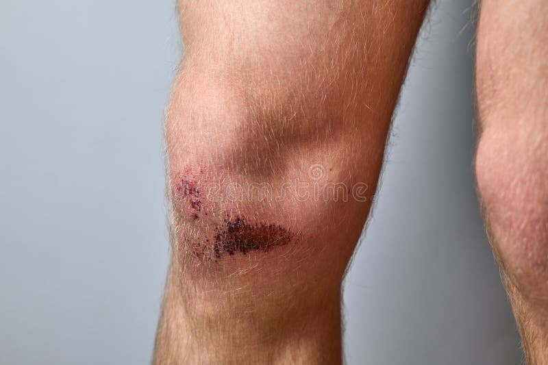 Scratch, Knee Wound on a Man& X27;s Knee Stock Photo - Image of medical ...