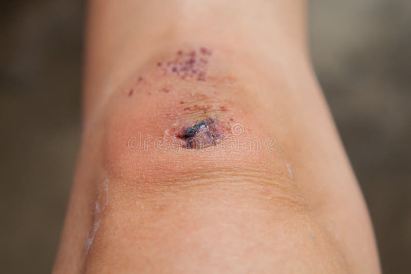 Scratch on the knee. stock photo. Image of gash, closeup - 80766786