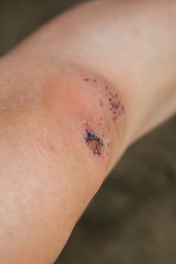 Scratch on the knee. stock photo. Image of anatomy, caucasian - 80766940