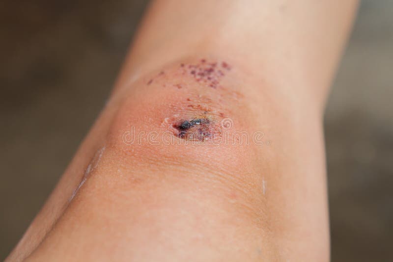 Knee Scratch Stock Photos - Download 878 Royalty Free Photos
