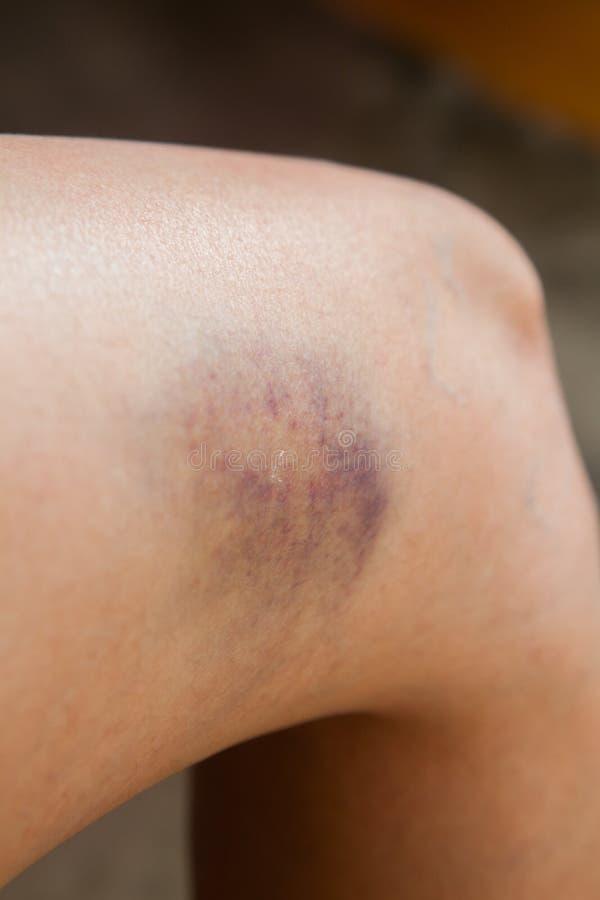 234 Wound Gash Stock Photos - Free & Royalty-Free Stock Photos from ...