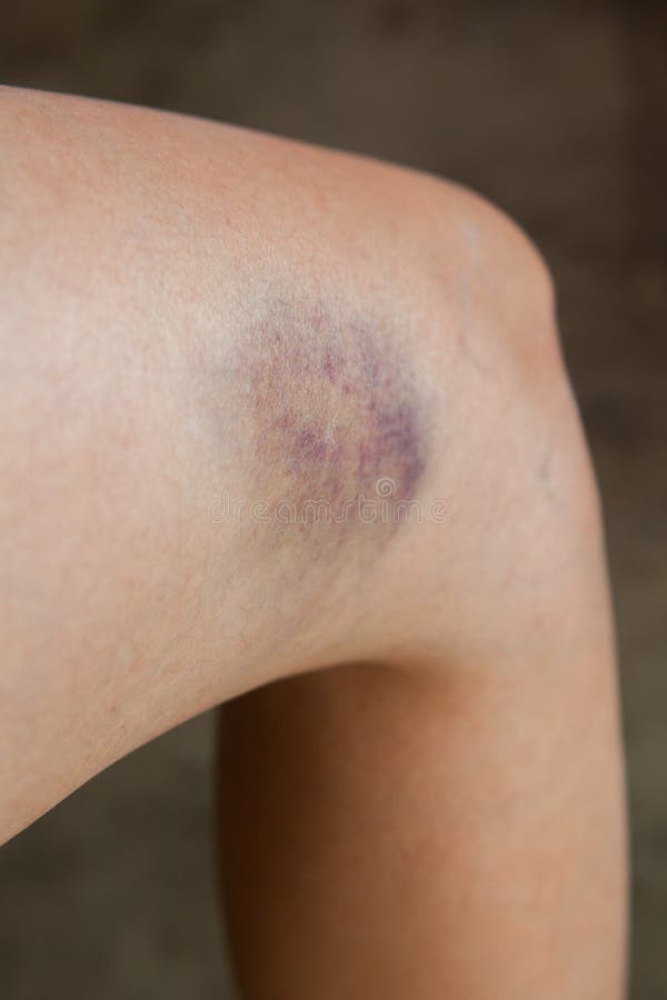Scratch on the knee. stock image. Image of hurt, injured - 80767207