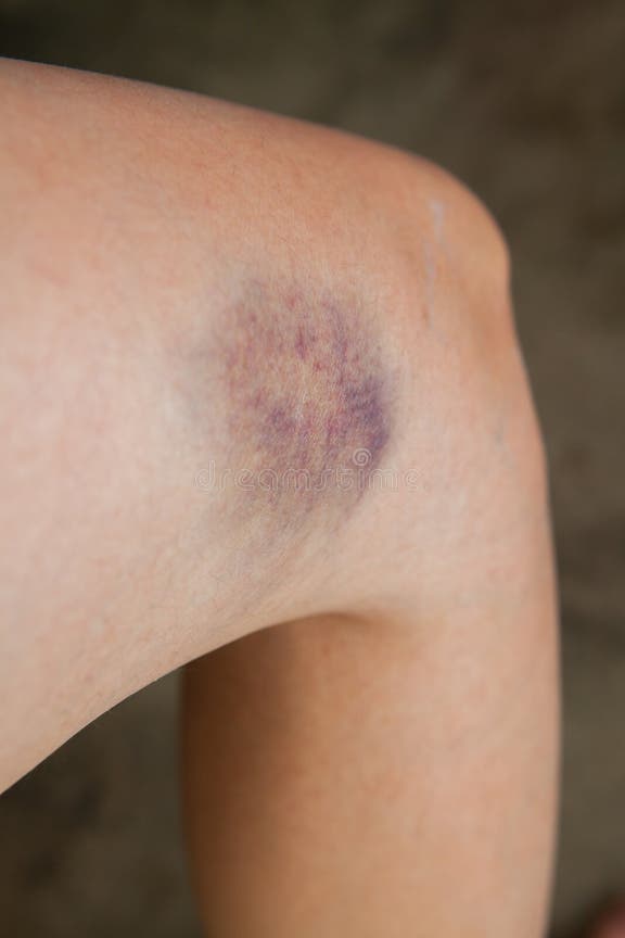 Scratch on the knee. stock photo. Image of human, emergency - 80766846