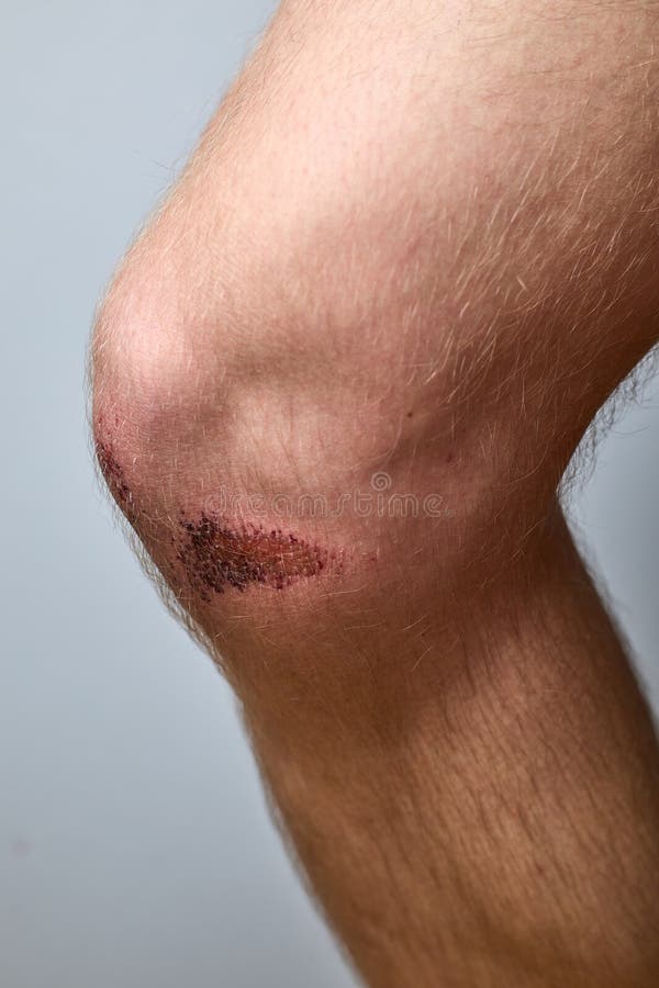 Scratch, Knee Wound on a Man& X27;s Knee Stock Image - Image of people ...