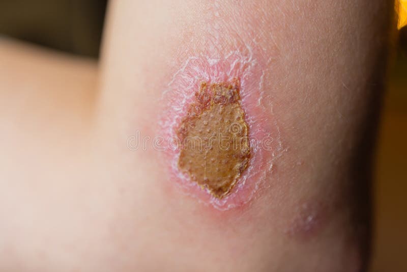 Scratch Lesion Caused by the Accident on Leg Skin. Stock Photo - Image ...