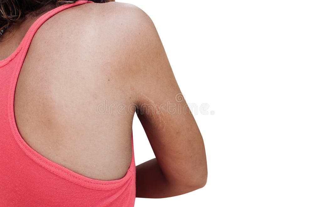 Scratch Mark and Wrinkle of Armpit Stock Photo - Image of hide, girl ...