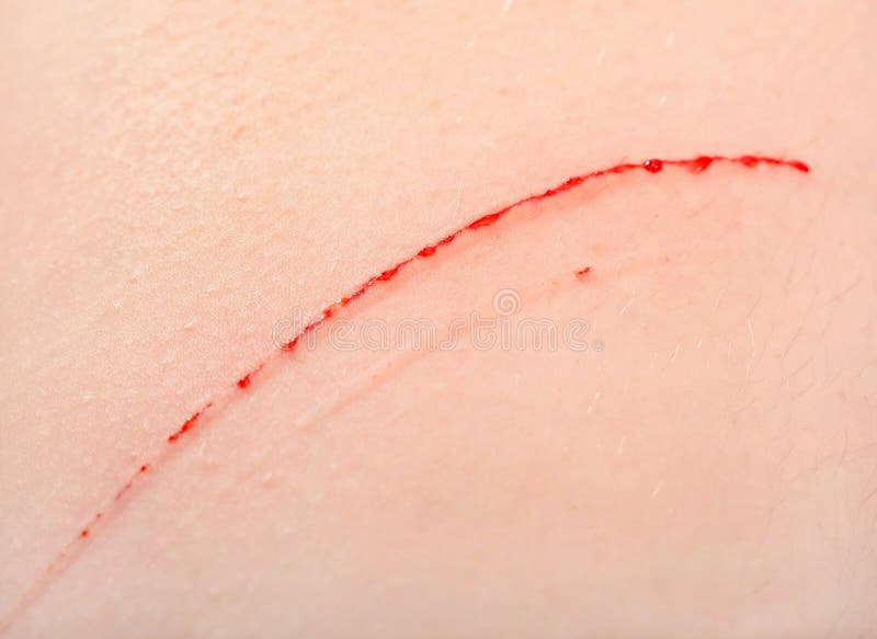Scratch Skin, Wound or Cut on the Skin, Red Blood. Hairy Part of a Man ...