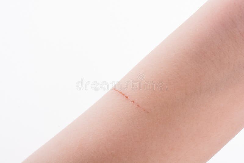 319 Scratch Scar Hand Stock Photos - Free & Royalty-Free Stock Photos ...