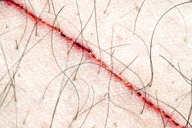 Scratch on the skin. stock photo. Image of cure, closeup - 63364380