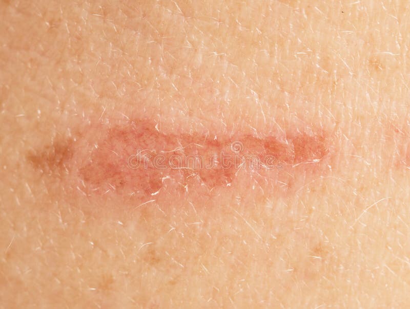 Scratch Skin, Wound or Cut on the Skin, Red Blood. Hairy Part of a Man ...