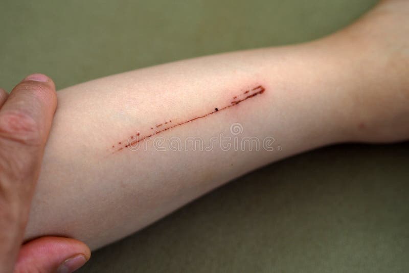 A Scratch Wound that Forms a Trace on the Leg, the Child`s Leg is ...