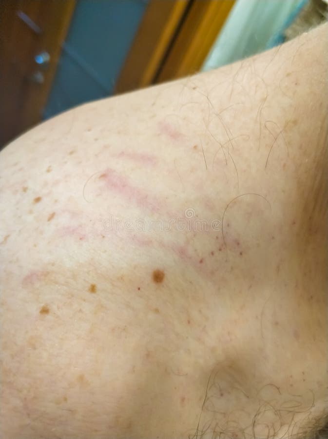 Scratched male body. stock photo. Image of couple, violence - 245888002