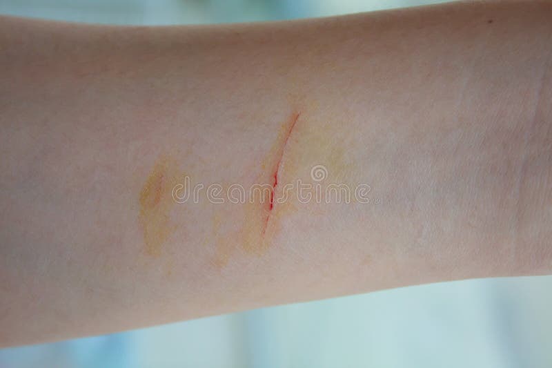 Scratched wound on arm stock photo. Image of medical - 77956418