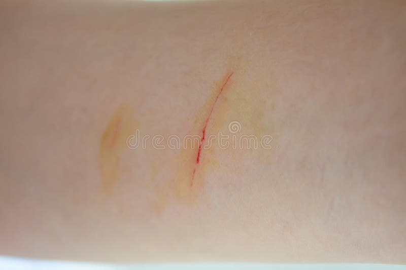 Scratched wound on arm stock photo. Image of medical - 77956418