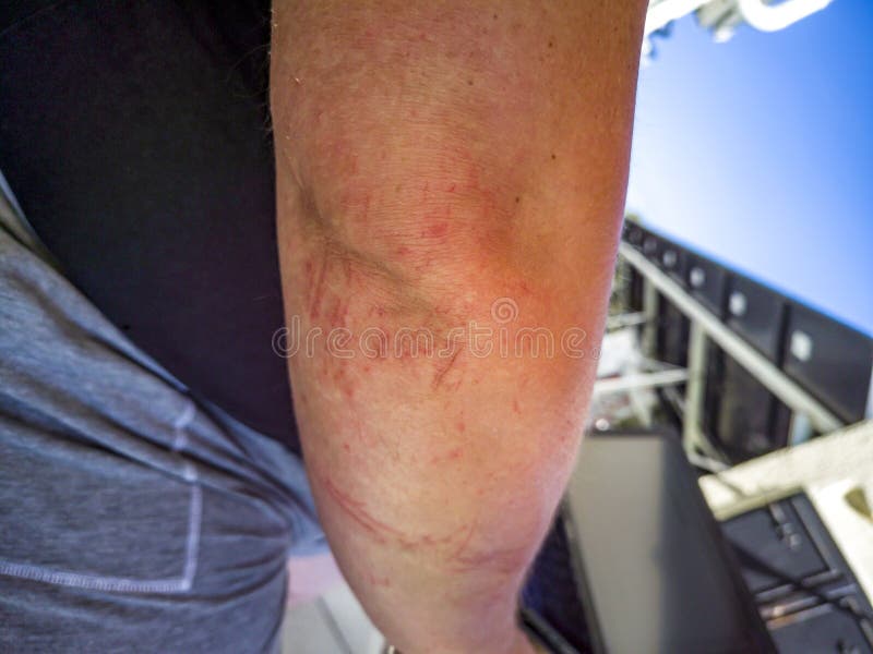 Scratchedd Male Arm after an Accident Stock Photo - Image of allergy ...