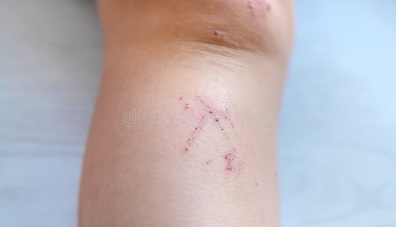 Scratches on a Child S Leg. Selective Focus Stock Photo - Image of girl ...