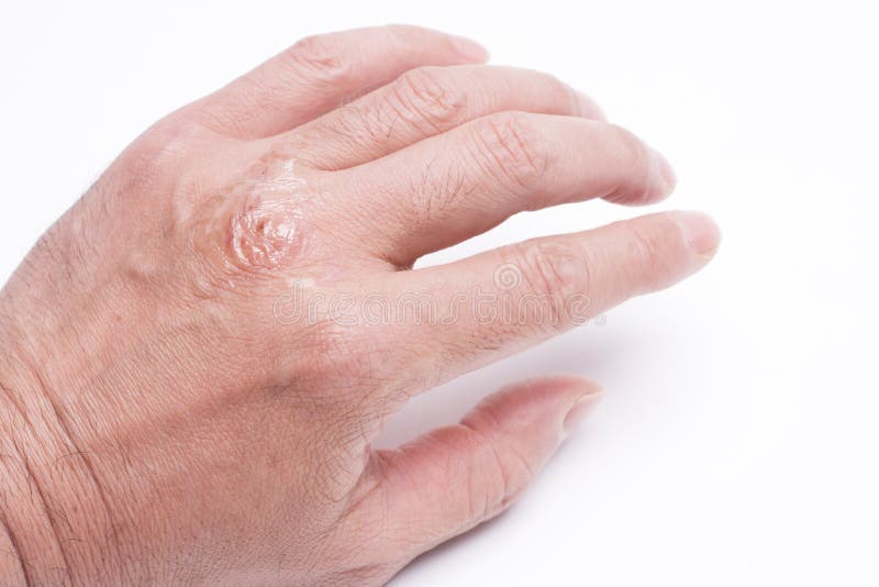 Scratches on the hand stock photo. Image of hand, dispose - 84695790