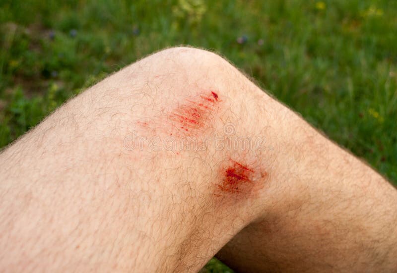 Scratches on the knee stock photo. Image of injury, blood - 31437348