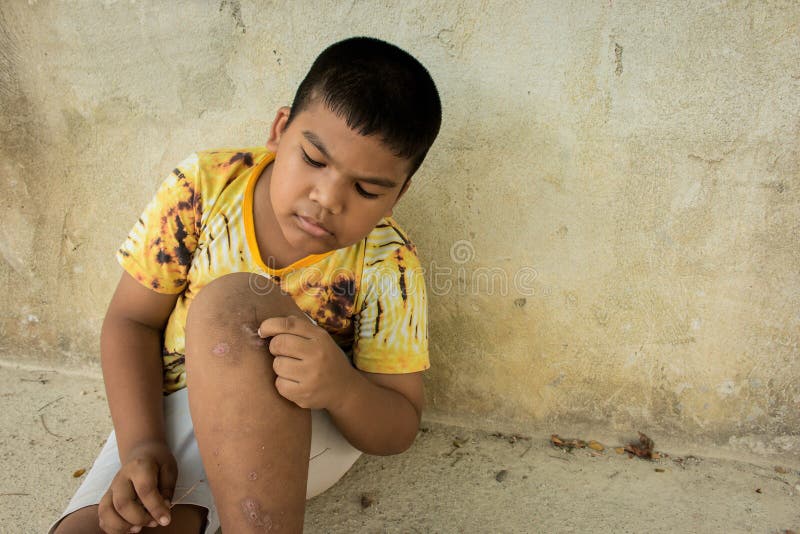 Scratching the Blisters Scab on Leg Stock Photo - Image of health ...