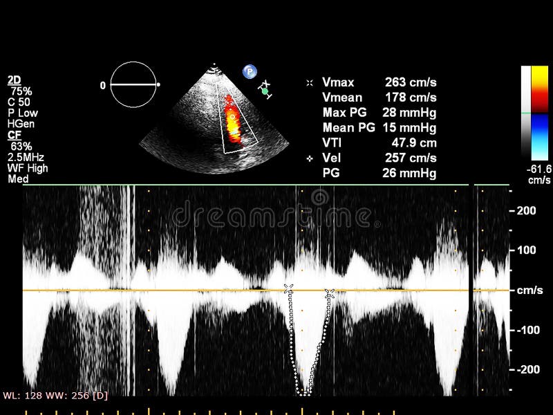 Screen of Echocardiography Ultrasound Machine Stock Photo - Image of ...