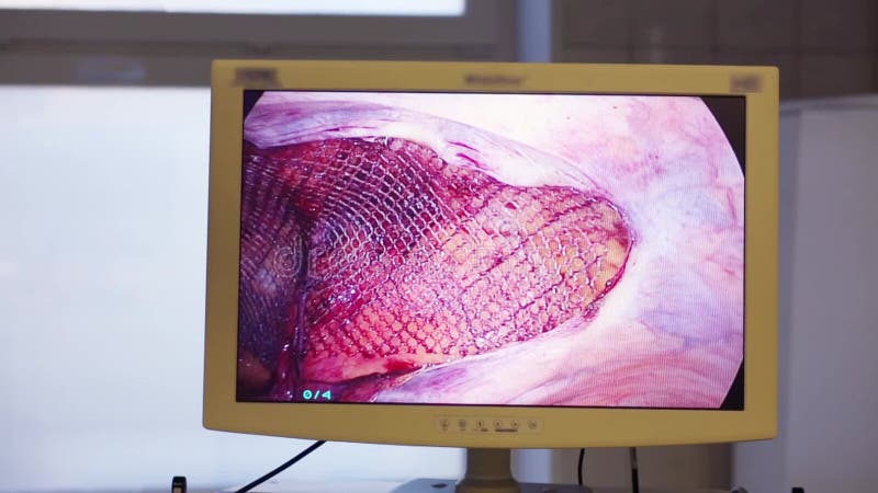Screen Showing Endoscopic Surgery with Plastic of Stock Video - Video ...